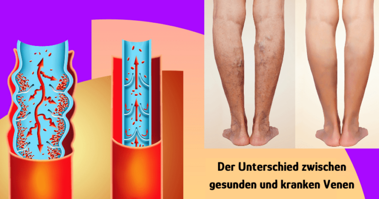 Wunderbar Wasser In Beinen Ursache Ebenbild