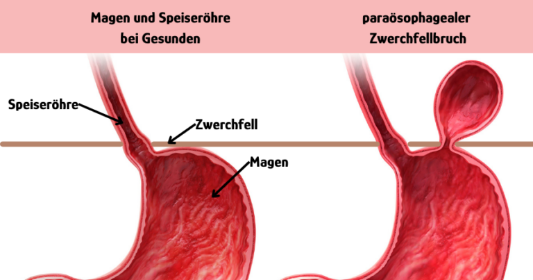 Zwerchfellbruch: Alles, was du wissen musst - Nico Lorenz Atemtraining